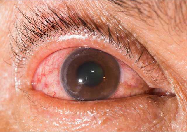 early glaucomatous changes